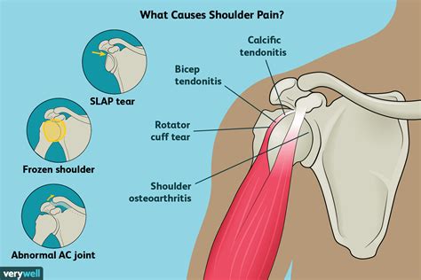 Shoulder Pain Causes Treatment And When To See A Doctor