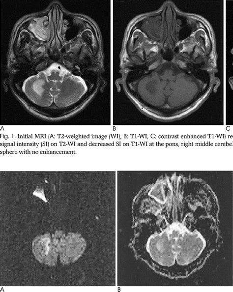 DWI A And ADC Map B Showed High Signal Intensity SI On DWI And Download Scientific