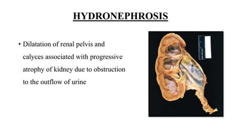 Obstructive Uropathy Ppt Pptx