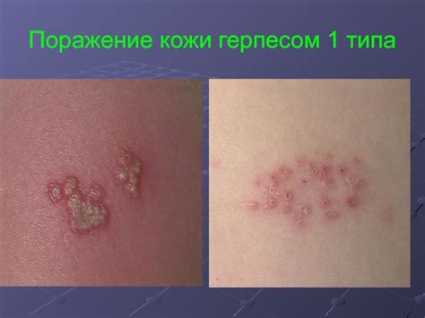 Герпес презентация, доклад