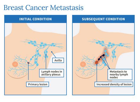 Stage 4 Metastatic Breast Cancer Symptoms Survival Rate And More