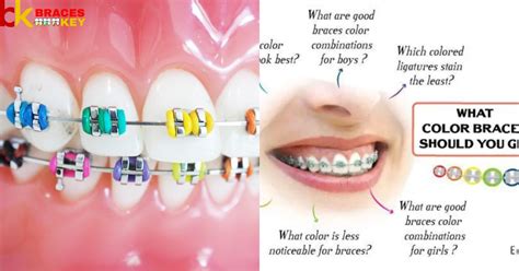 What Color Braces To Get Quiz At Donna Champion Blog