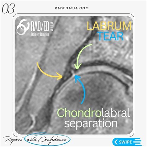 Hip Labrum Labral Tear Mri Radiology Radedasia