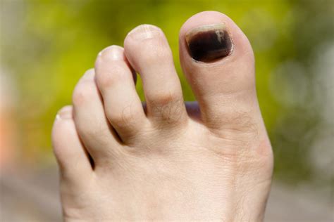 Black Toenail 6 Potential Causes