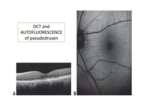 Age Related Macular Degeneration Pptx