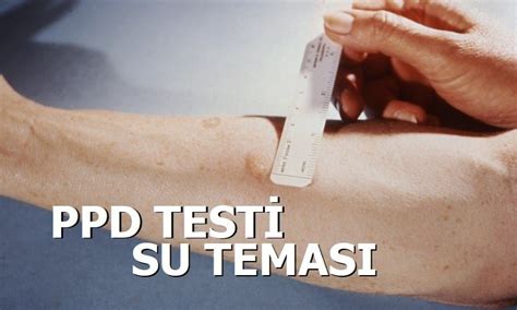 Ppd Testi Nasıl Yapılır Ppd Testi Ne Için Yapılır Tr