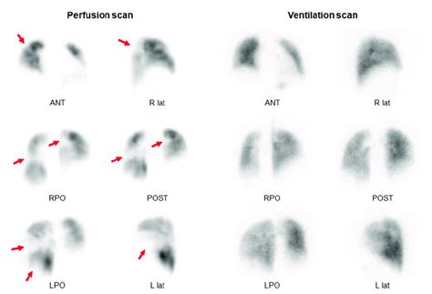 V Q Scan Findings Demonstrating Multiple Perfusion Defects In Both Download Scientific Diagram
