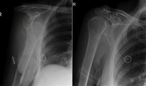 Anterior Shoulder Dislocation Radiology At St Vincents University