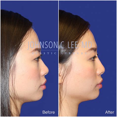 Non Surgical Photo Gallery Dr Johnson C Lee Md