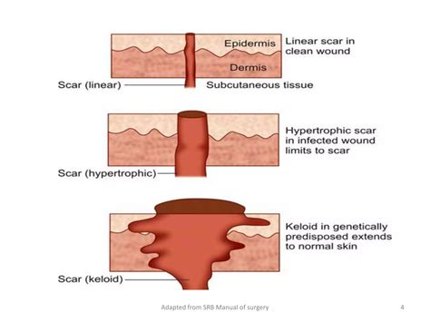 Discuss Keloid And Hypertrophic Scars Pdf