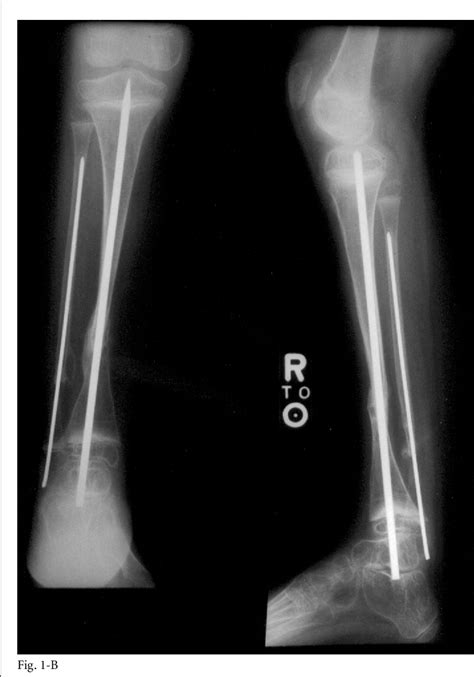 Intramedullary Rod Tibia