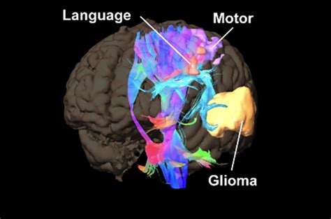 Real Human Brain Tumor Brain Tissue Donation Explained Answers To