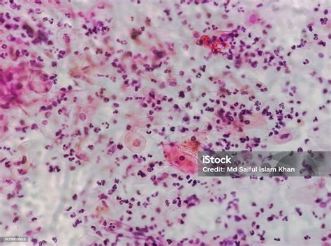 자궁 경부 세포진 검사의 현미경 사진 Hpv 관련 변화가있는 염증성 도말 자궁 경부암 증권 시세 표시기 자궁 경부 세포 검사에 대한 스톡 사진 및 기타 이미지 Istock