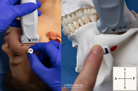 Maxillary Nerve Block Technique