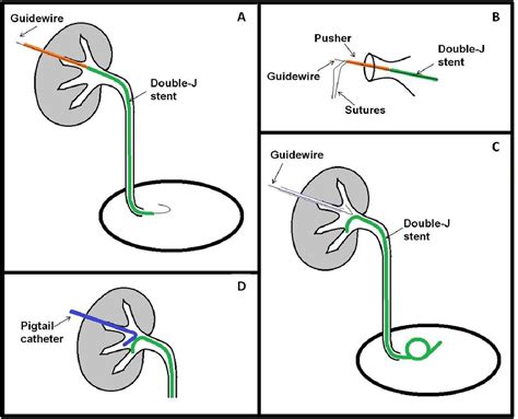 Figure 2 From Complex Antegrade Ureteric Stenting Unusual And