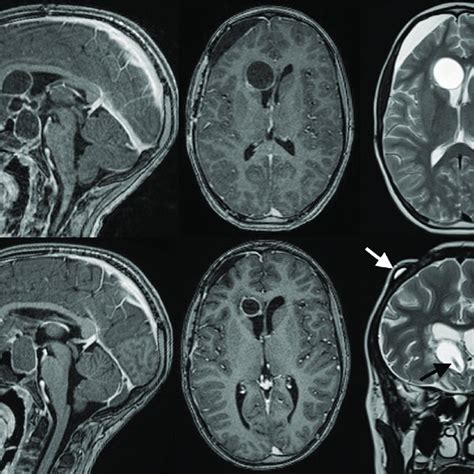 T1 Weighted Gadolinium Enhanced And T2 Weighted Magnetic Resonance