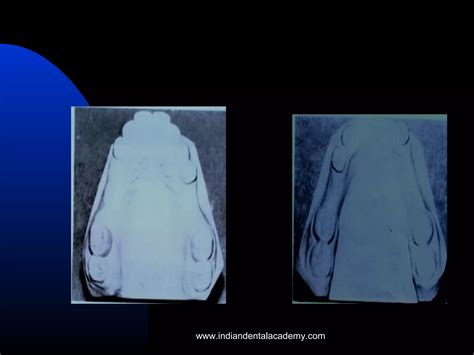 Classification Of Rpd Dentist Laboratory Ppt