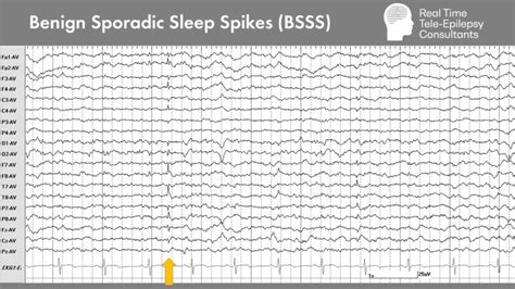 Real Time Tele Epilepsy Consultants Rttc On Linkedin Spikes Of Low Voltage Short Duration