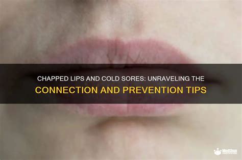 Chapped Lips And Cold Sores Unraveling The Connection And Prevention