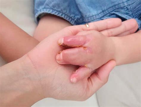 Síndrome De Apert Apertcras Asociación Nacional Del Síndrome De Apert