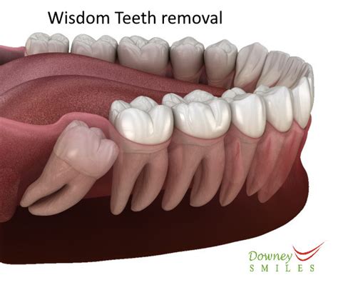 Wisdom Teeth Removal Recovery Time