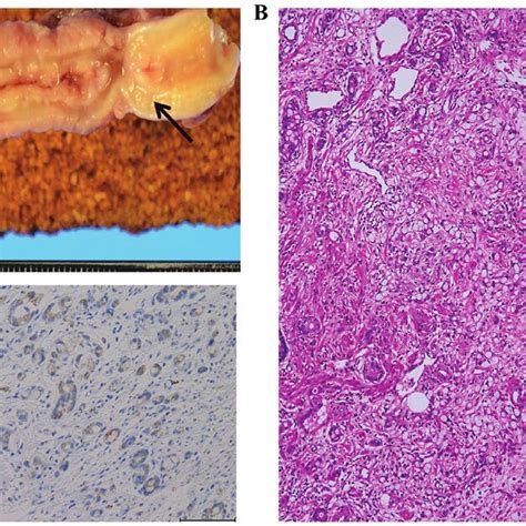 Representative Case Of A Low Grade Appendiceal Mucinous Neoplasm With Download Scientific
