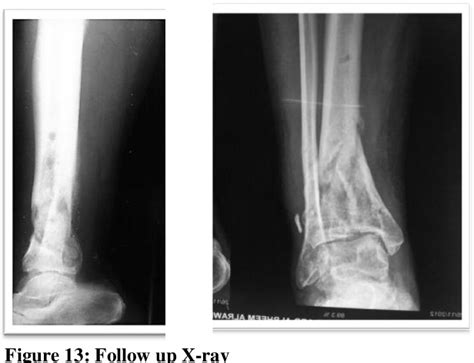 Figure 1 From Management Of Tibial Pilon Fractures With Spanning External Fixator Supported By K
