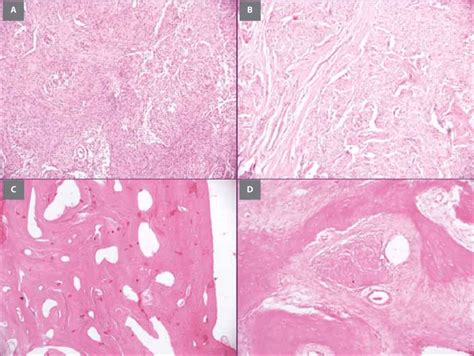 A Photomicrograph From The Intracranial Tumor Showing A Transitional