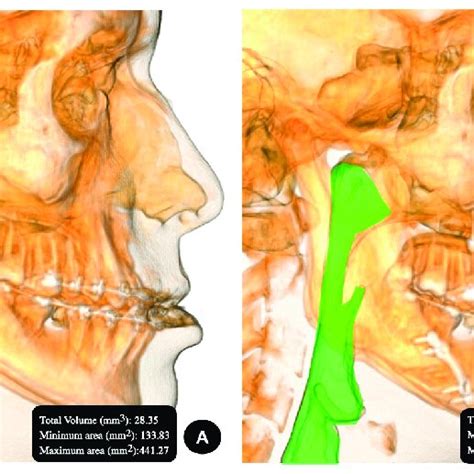 Group Iii Angle Class Iii Facial Deformity In The A Preoperative