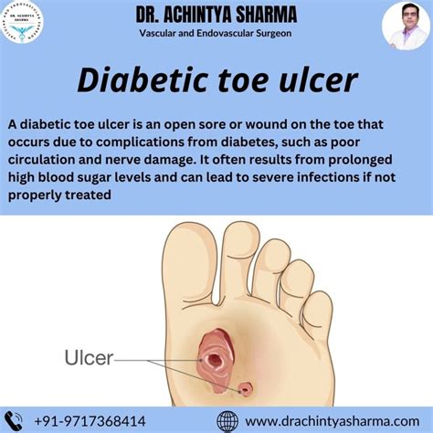 Diabetes Foot Care Treating And Preventing Ulcers On The Toe
