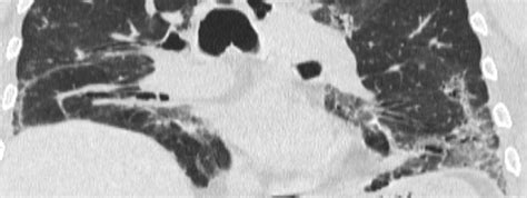 Raiqc Packages Package Interstitial Lung Disease On Hrct