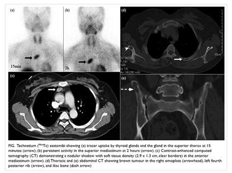 Ct Scan Thyroid At Rickey Turman Blog