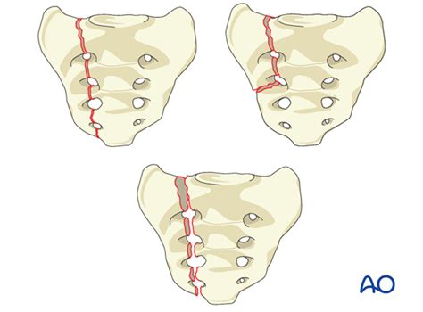 Aospine Classification
