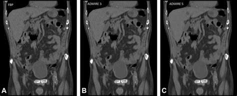 Examples Of Image Quality Comparisons In Full Dose Abdominal Ct Download Scientific Diagram