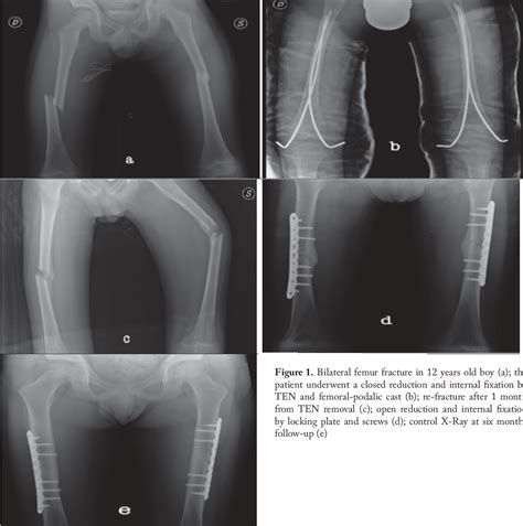 Figure 1 From Locking Plate Fixation In Pediatric Femur Fracture Evaluation Of The Outcomes In