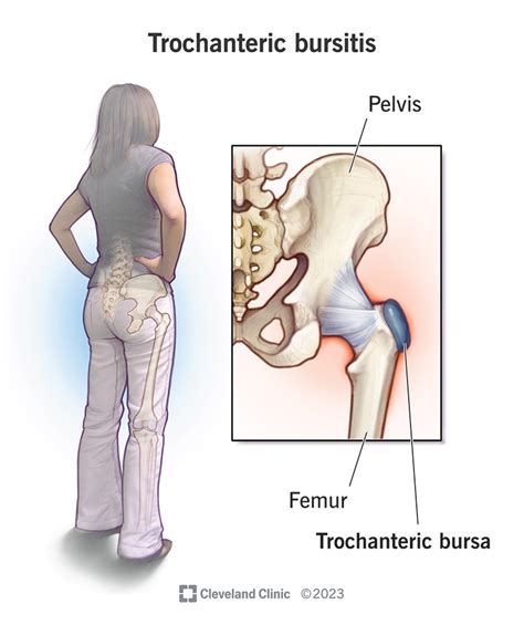 Severe Symptoms Of Hip Bursitis