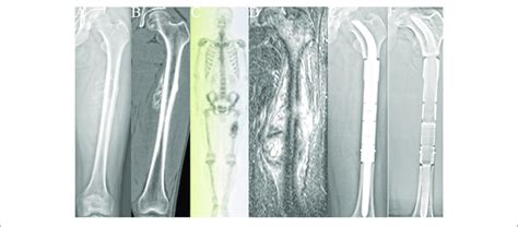 All Patients Underwent En Bloc Tumor Resection Followed By Download Scientific Diagram