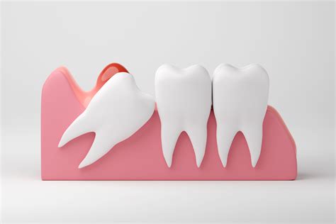 Wisdom Tooth Extraction And Surgery In Singapore Thomson Medical