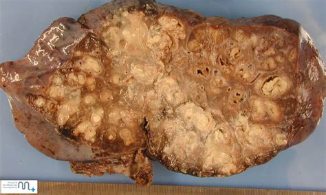 Bronchiectasis Human Pathology