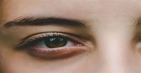 ¿qué Son Las Ojeras Y Que Tratamientos Recomendamos Dermamedic