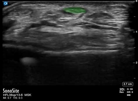 Foot And Ankle Anterior Recess Extensor Hallucis Longus Image Sonosite Institute For Point Of