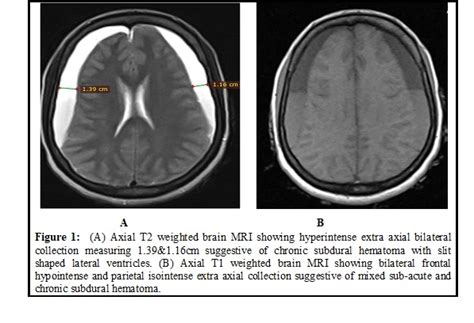 Ajns African Journal Of Neurological Sciences Bilateral Subdural Hematoma A Rare
