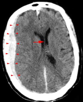 Head Ct