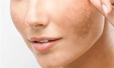 ℹ Melasma Causas Y Tratamiento