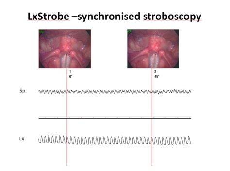 Laryngeal Stroboscopy Pdf