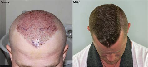 33 Diffuse Thinning Hair Transplant Sumeyaaarith