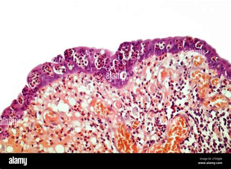 Ulcerative Colitis Light Micrograph LM Of A Section Through An Affected Tissue Ulcerative