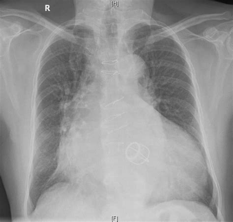 Valve Replacement Chest X Ray At Rickey Park Blog