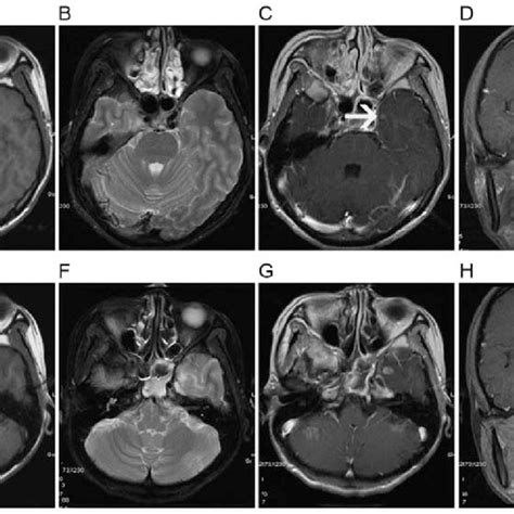 A Solid Enhanced Nodular Lesion Was Detected As The Only Abnormality To