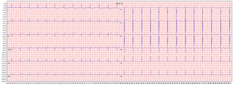 Examples Of Left Ventricular Hypertrophy Lvh Ecg Library